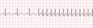 Cardiac EKGs on the NCLEX - The NCLEX Tutor